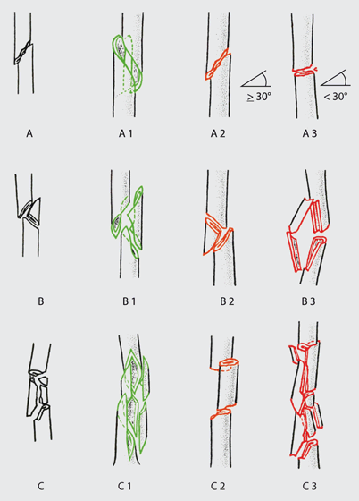 Femurschaftfrakturen | SpringerLink