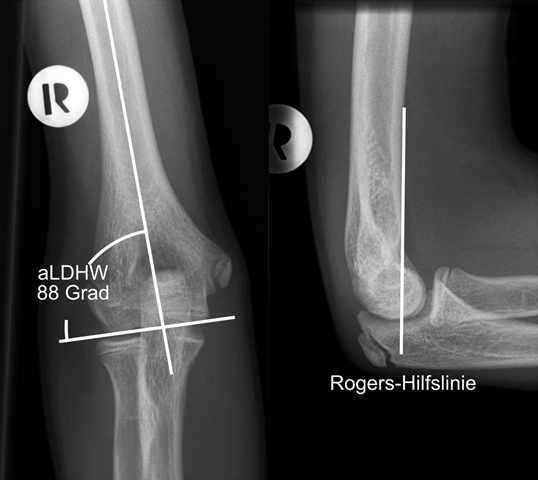 Pseudarthrose des kindlichen Condylus radialis humeri mit ...