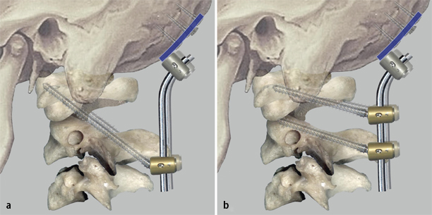 Operationsverfahren zur Stabilisierung der oberen Halswirbelsäule ...
