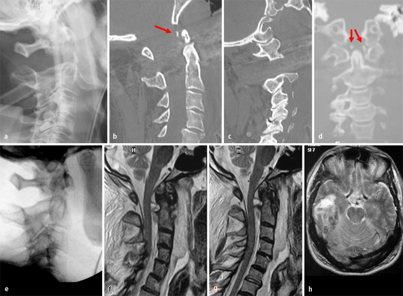 Verletzungen der oberen Halswirbelsäule | SpringerLink