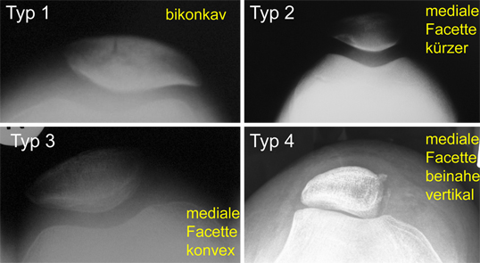 Patellaluxationen | SpringerLink