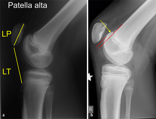 Patellaluxationen | SpringerLink