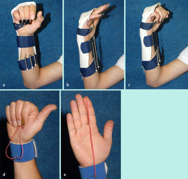 Primärversorgung komplizierter Beugesehnenverletzungen an der Hand ...