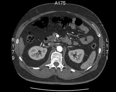 Zweizeitige Milzruptur am 13. postraumatischen Tag nach initial ...