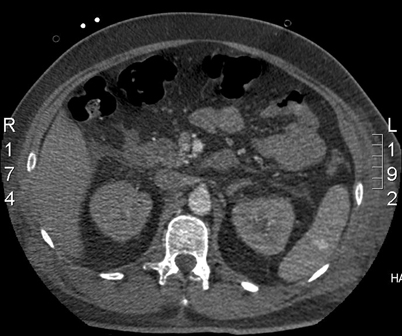 Zweizeitige Milzruptur am 13. postraumatischen Tag nach initial ...