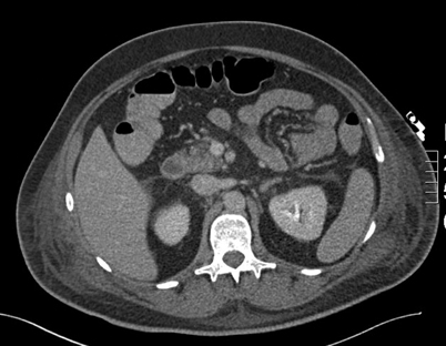 Zweizeitige Milzruptur am 13. postraumatischen Tag nach initial ...