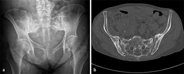 Insuffizienzfrakturen des Beckenrings | SpringerLink