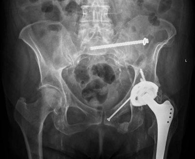 Insuffizienzfrakturen des Beckenrings | SpringerLink