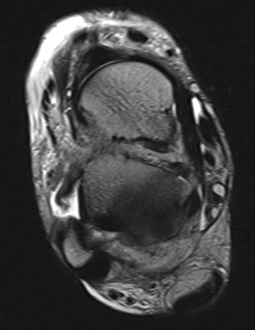 Die Verletzung des lateralen Kapsel-Band-Apparats des Sprunggelenks ...