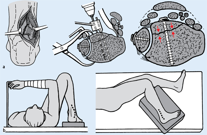 Der posteriore Malleolus bzw. das Volkmann-Dreieck | SpringerLink
