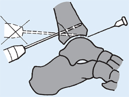 Der posteriore Malleolus bzw. das Volkmann-Dreieck | SpringerLink
