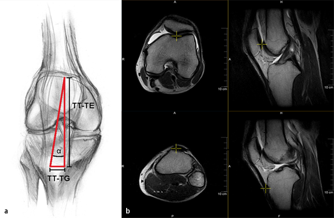 MRT des Kniegelenks unter besonderer Berücksichtigung der ...