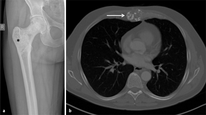Bildgebende Diagnostik der Knochensarkome | SpringerLink
