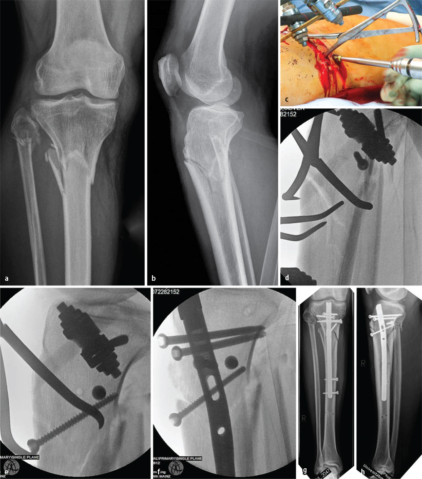 Nagelung metaphysärer Frakturen | SpringerLink