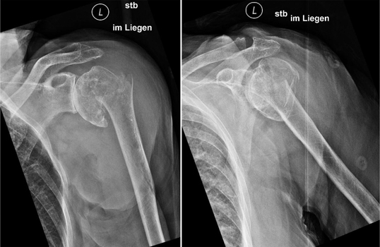 Augmentationstechnik am proximalen Humerus | SpringerLink