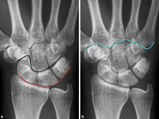 Carpus und distales Radioulnargelenk | SpringerLink