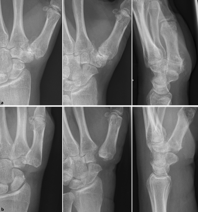 Aktuelle Aspekte zur Therapie der Rhizarthrose | SpringerLink