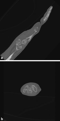 Die Kompression des Nervus medianus durch ein luxiertes Mondbein ...