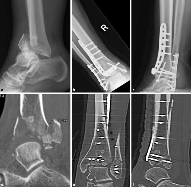 Operationstechnik und deren Ergebnisse der Pilon-tibiale-Fraktur ...