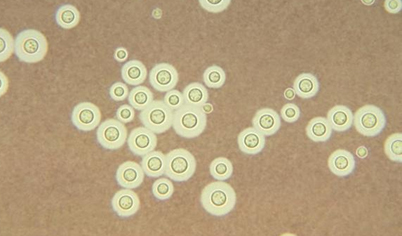 Neurologische Komplikationen der HIV-Infektion | SpringerLink