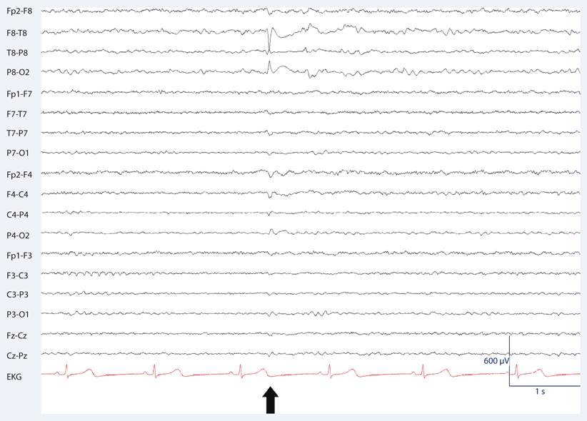 Bedeutung des EEG in der Epilepsiediagnostik | SpringerLink
