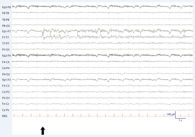 Bedeutung des EEG in der Epilepsiediagnostik | SpringerLink