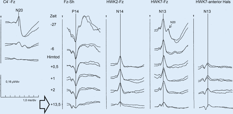 Irreversibilitätsnachweis der klinischen Ausfallssymptome des Gehirns ...