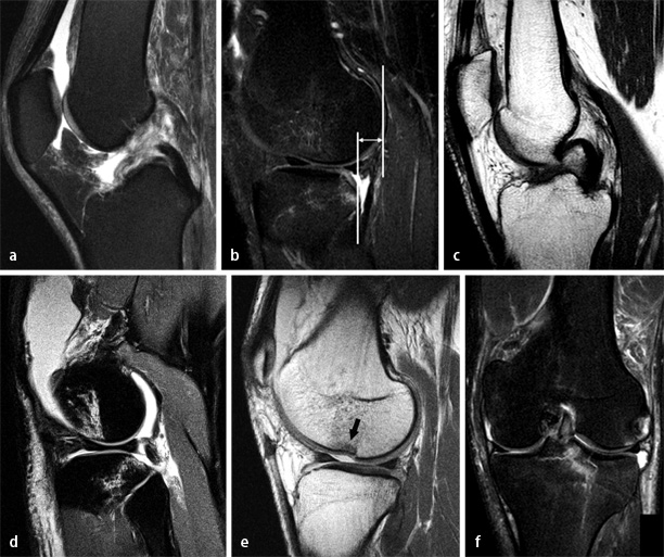 MRT des Kniegelenks | SpringerLink