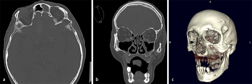 Traumatische Läsionen der Orbita | SpringerLink
