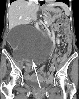 Erkrankungen von Peritoneum und Mesenterium | SpringerLink