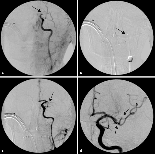 Thrombolyse der Arteria cerebri media | SpringerLink