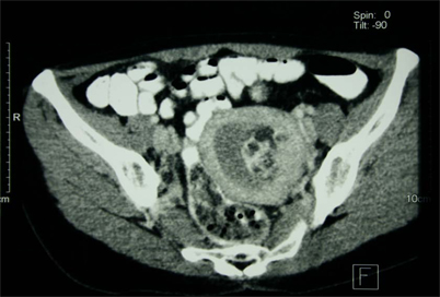 Tumoren des weiblichen Beckens | SpringerLink