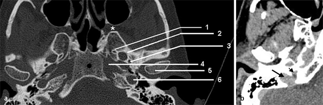 Anatomie der Schädelbasis und Hirnnerven in der Schnittbildgebung ...