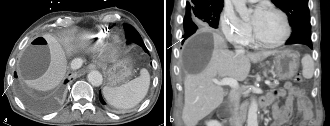 Erkrankungen des hepatobiliären Systems als Ursache des akuten Abdomens ...