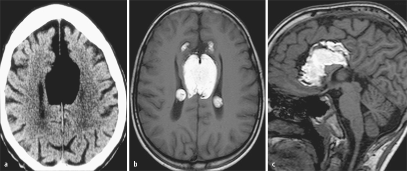Corpus callosum | SpringerLink