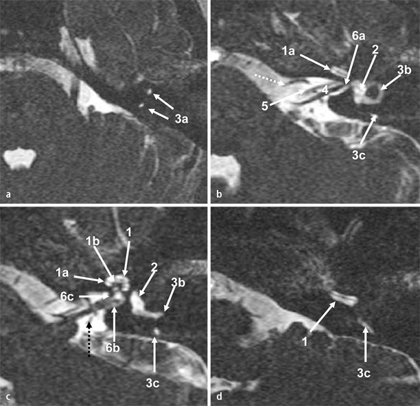 Bildgebung des Schläfenbeins | SpringerLink