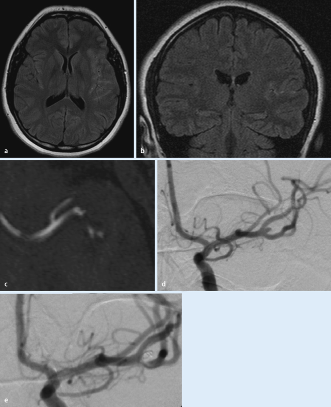 Bildgebende Diagnostik der Subarachnoidalblutung | SpringerLink