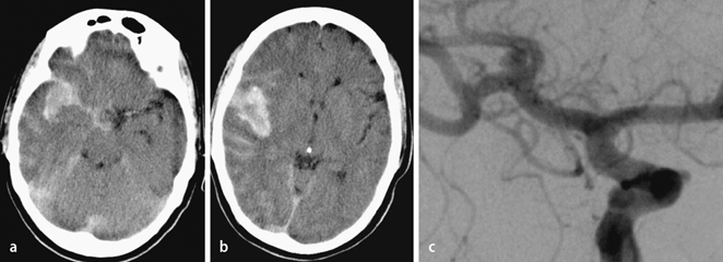 Bildgebende Diagnostik der Subarachnoidalblutung | SpringerLink