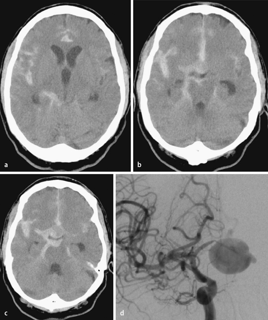 Bildgebende Diagnostik der Subarachnoidalblutung | SpringerLink