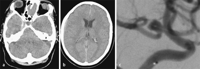 Bildgebende Diagnostik der Subarachnoidalblutung | SpringerLink