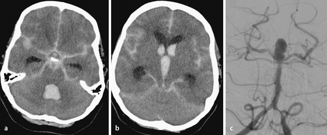 Bildgebende Diagnostik der Subarachnoidalblutung | SpringerLink