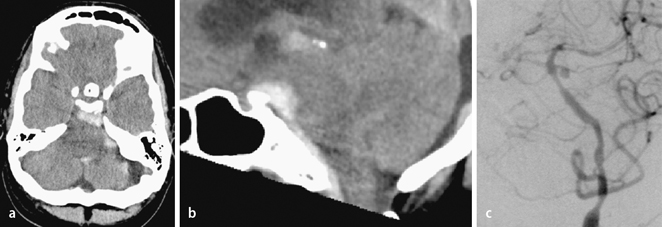 Bildgebende Diagnostik der Subarachnoidalblutung | SpringerLink