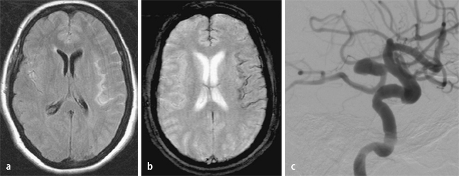 Bildgebende Diagnostik der Subarachnoidalblutung | SpringerLink