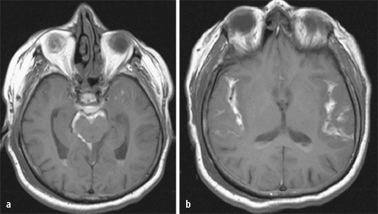 Bildgebende Diagnostik der Subarachnoidalblutung | SpringerLink