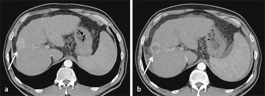 Moderne CT- und PET/CT-Bildgebung der Leber | SpringerLink