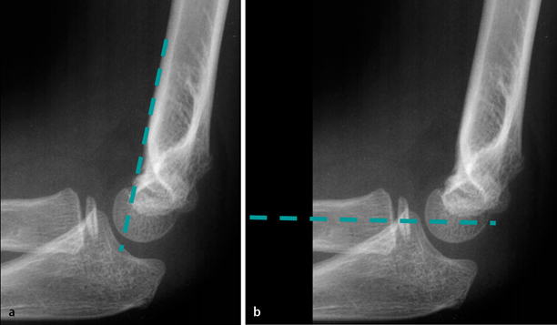 Skeletttraumatologie im Wachstumsalter | SpringerLink