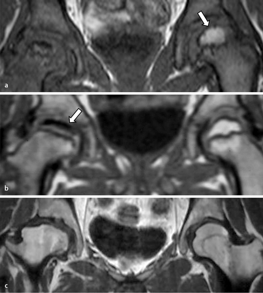 Koxarthrose – eine radiologische Annäherung und Leitfaden | SpringerLink