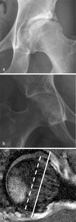 Koxarthrose – eine radiologische Annäherung und Leitfaden | SpringerLink