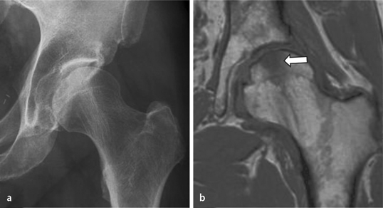 Koxarthrose – eine radiologische Annäherung und Leitfaden | SpringerLink