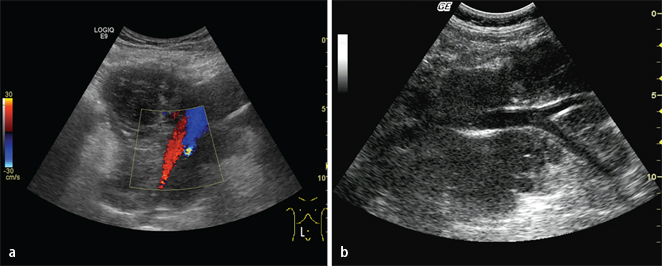 Ultraschall in der Diagnostik maligner Lymphome | SpringerLink